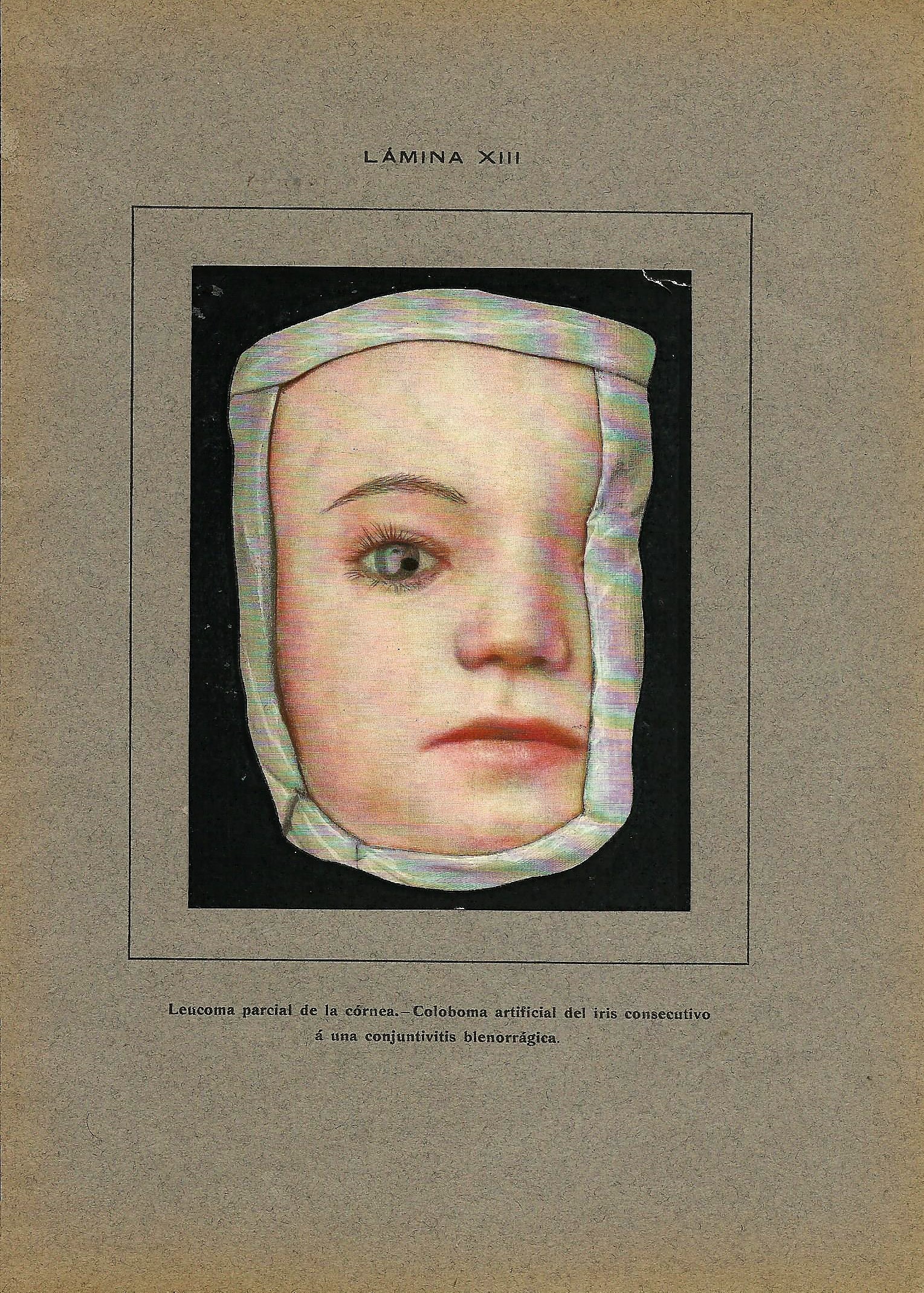 Leucoma parcial de la cornea | Blog de Tomás Cabacas