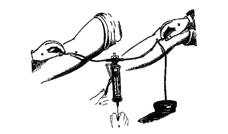 Transfusor de Schliep | Blog de Tomás Cabacas