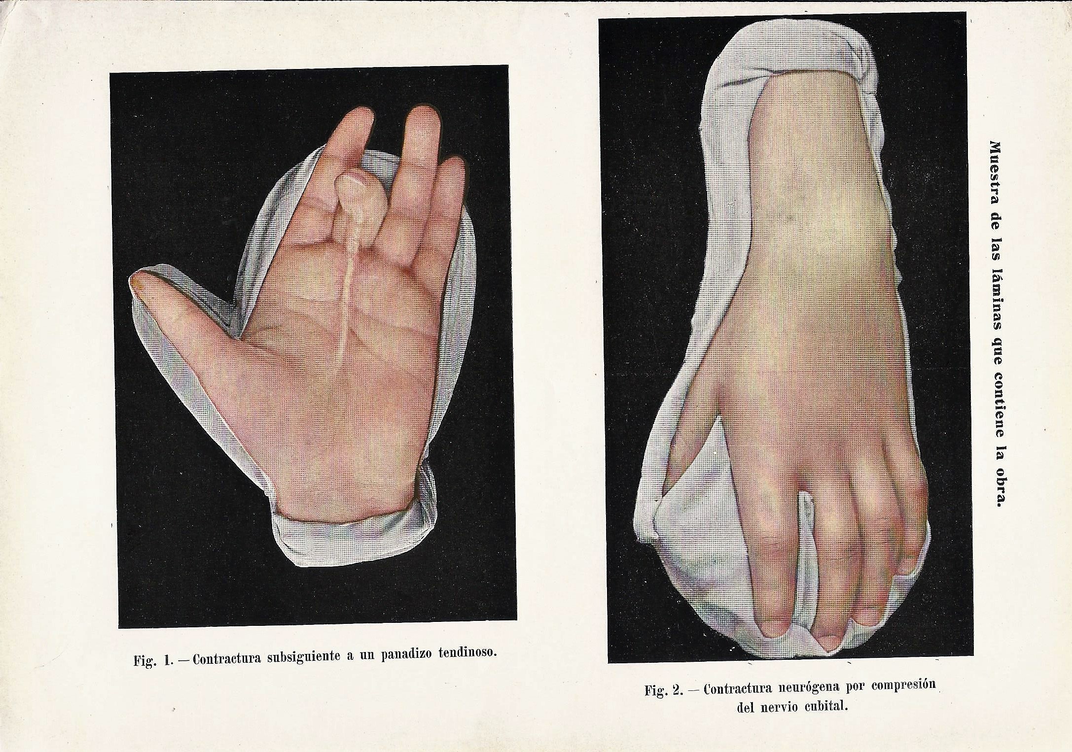 Contracturas de la mano | Blog de Tomás Cabacas