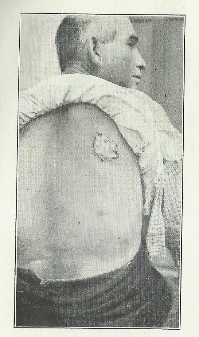 Tratamiento de un ántrax o carbunco por fulguración con el Aparato ...