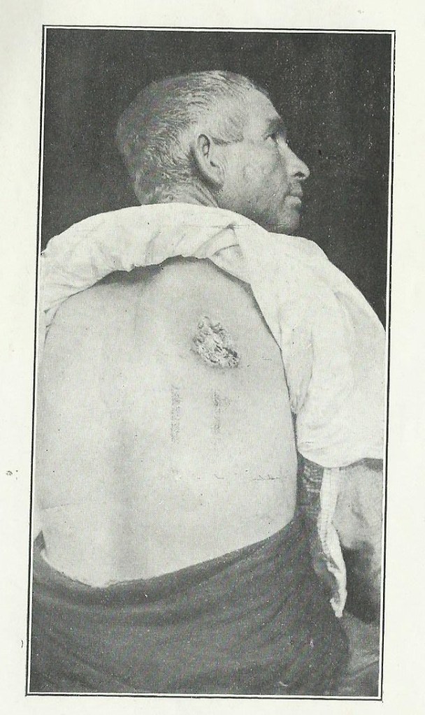 Tratamiento de un ántrax o carbunco por fulguración con el Aparato ...