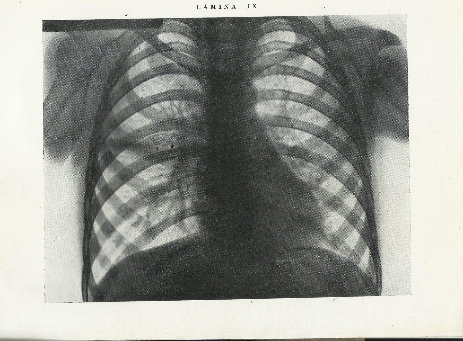 Radiografía de tuberculosis hiliar. Año 1931 | Blog de Tomás Cabacas