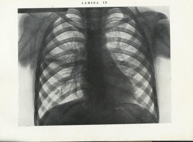 Radiografía de tuberculosis hiliar. Año 1931 | Blog de Tomás Cabacas