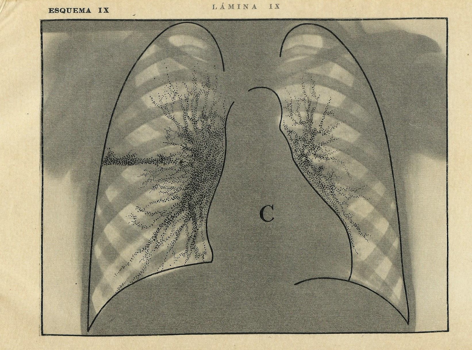 Radiografía de tuberculosis hiliar. Año 1931 | Blog de Tomás Cabacas