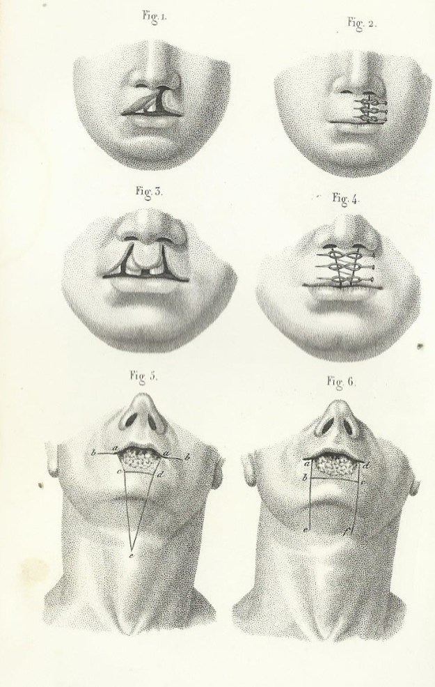 Tratamiento quirúrgico del labio leporino en el siglo XIX | Blog de ...
